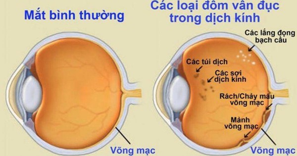 Hiện tượng “ruồi bay” trong mắt có nguy hiểm?
